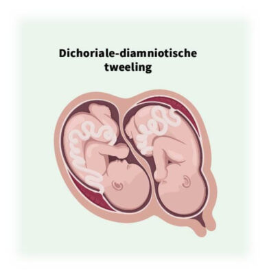 Hoe ontstaan eeneiige tweelingen? - Zwanger en nu