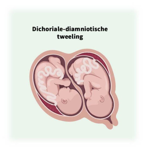 Hoe ontstaan eeneiige tweelingen? - Zwanger en nu