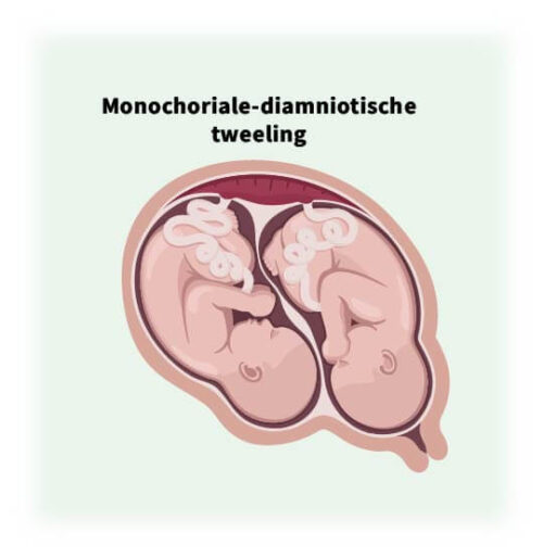 Hoe ontstaan eeneiige tweelingen? - Zwanger en nu